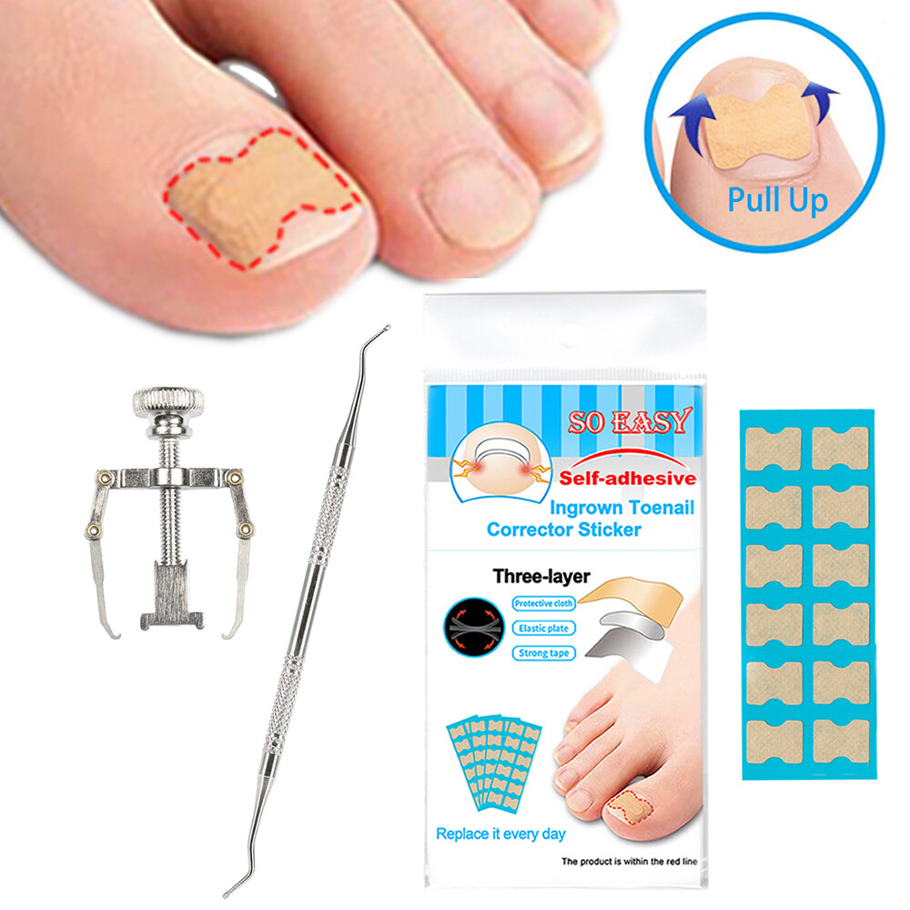Ingrown Nail Correction Kit Ingrown Toenail Stickers Toe Nail Clamp ...