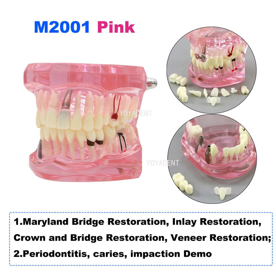 Teeth Model Dental Typodont Ortho Implant Pathological Perio Practice ...