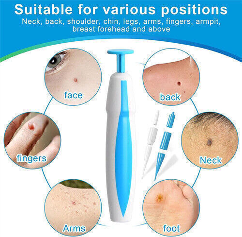 Auto Micro Skin Tag Remover Device Kit Safe Painless Removal 2-8 mm ...