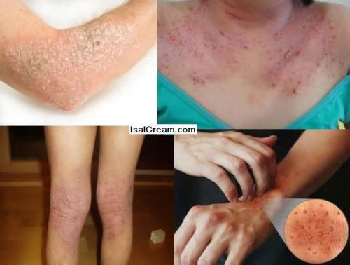 3 Lot of ISAL Atopy Eczema Cream Lotion./Made in USA 691054980648| eBay