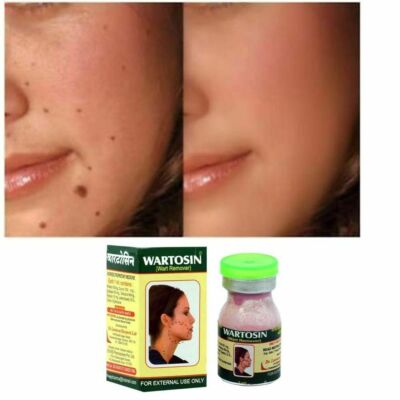 WARTOSIN Herbal Wart Remover Lotion Elevated Wart Skin Tag Marks Spots ...
