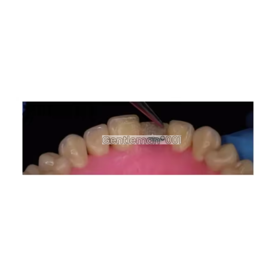 Dental Flexible Fiber Strip Band Retainer Glass Splint Loose Tooth ...