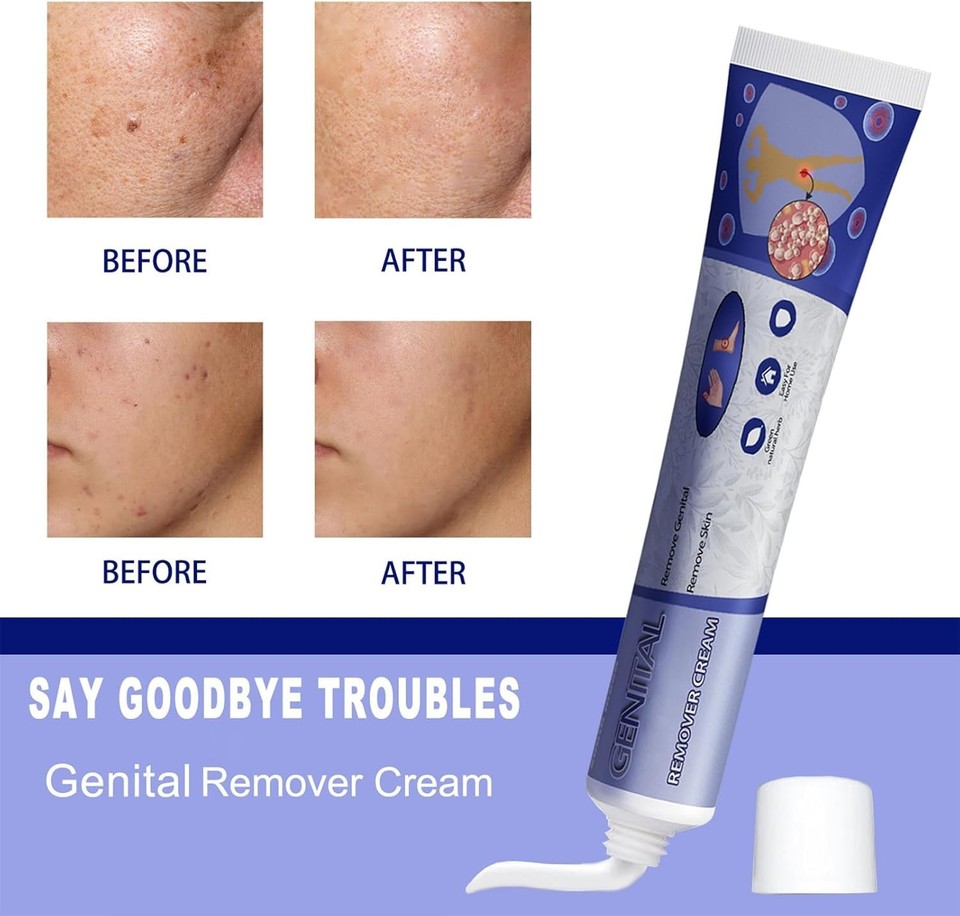 STRONG SKIN TAG REMOVER Cream NATURAL TREATMENT MOLES WARTS and TAGS ...
