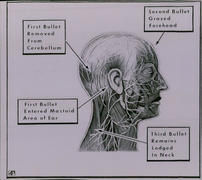 LG887 60s Wire Photo JFK ASSASSINATION BULLET DIAGRAM President Kennedy ...