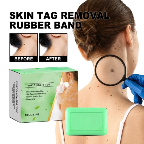 Smooth Skin Wart Elimination Soap, Natural Soap, Instant Wart Removal ...