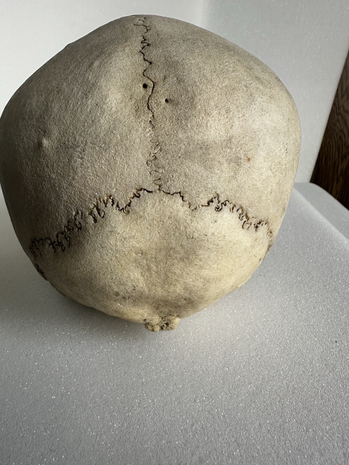 Authentic Human Skull-no Mandible-impacted Molar Was Cause Of Death ...