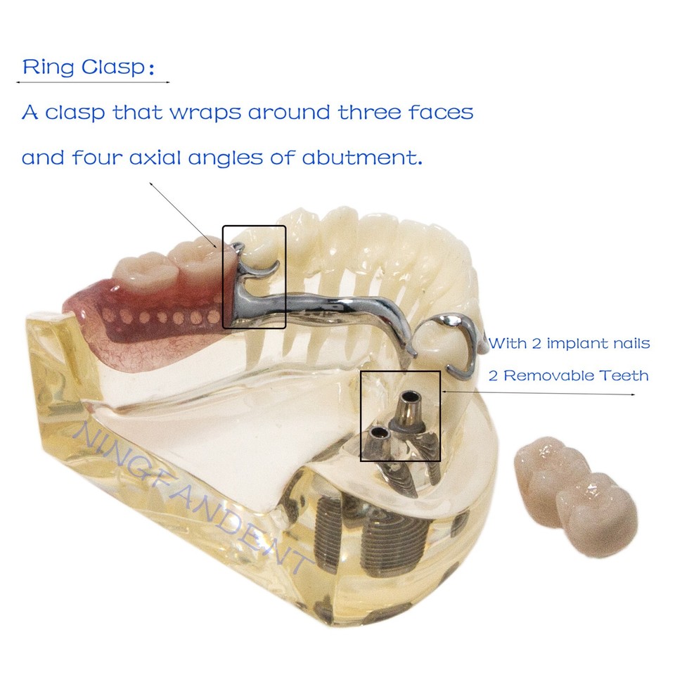 Dental Typodont Removable Partial Denture Model ,PRD Telescopic Crown ...