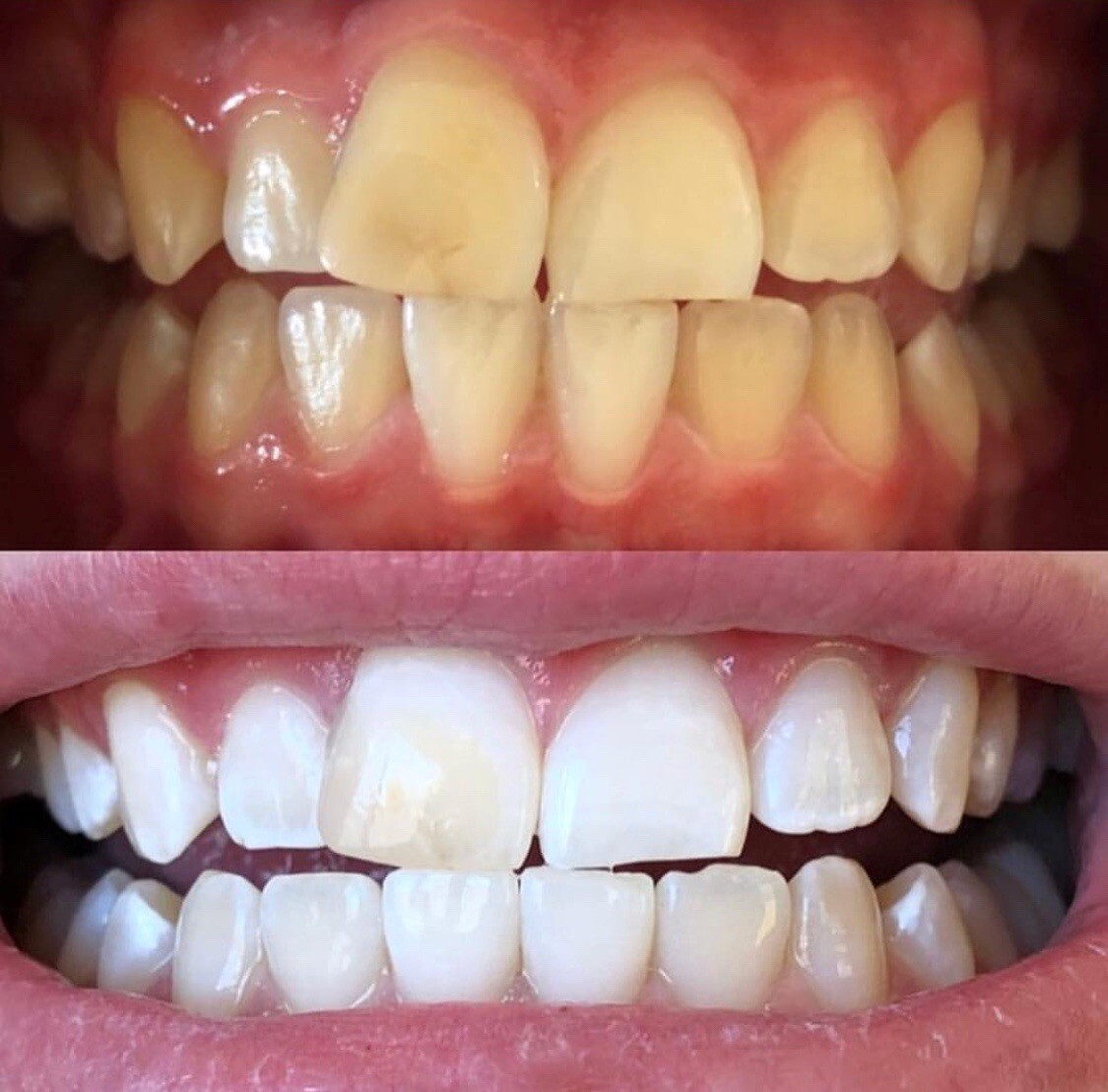 Pure White teeth whitening kit | eBay