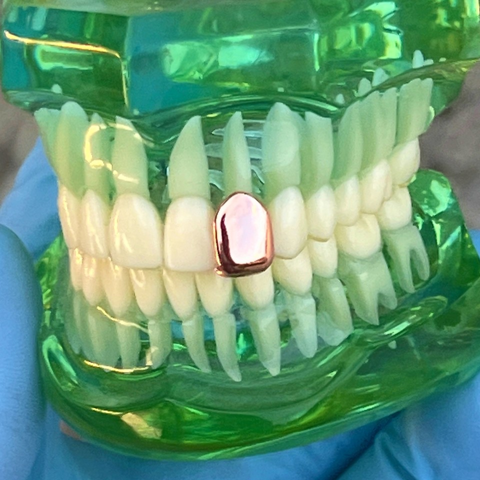 14K Rose Gold Plated Tooth Cap Real 925 Sterling Silver Single One ...