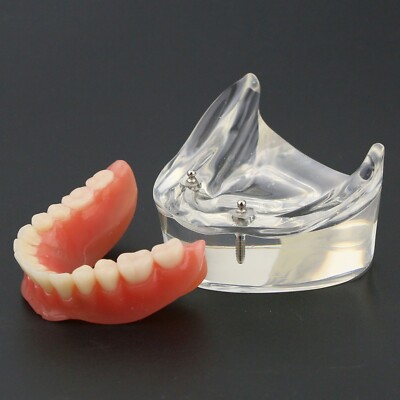 Dental Implant Teeth Model Mandibular Overdenture Restoration 2 Lower ...