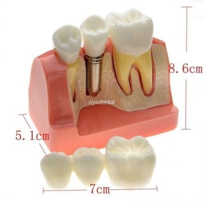 Dental Demonstration Teeth Model Implant Crown Bridge Model for Patient ...