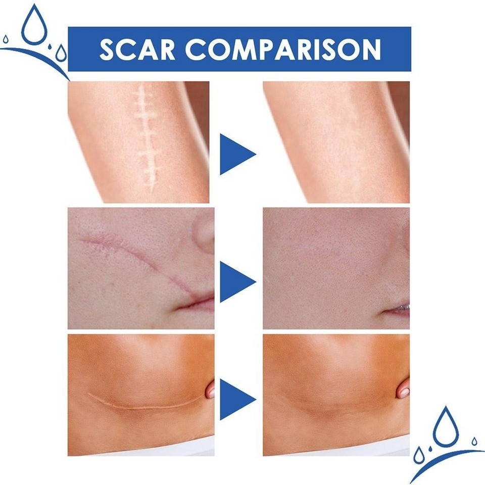 Scar Lightening Cream, Scar Removal Cream Skin Repair Scar HOT Remover ...