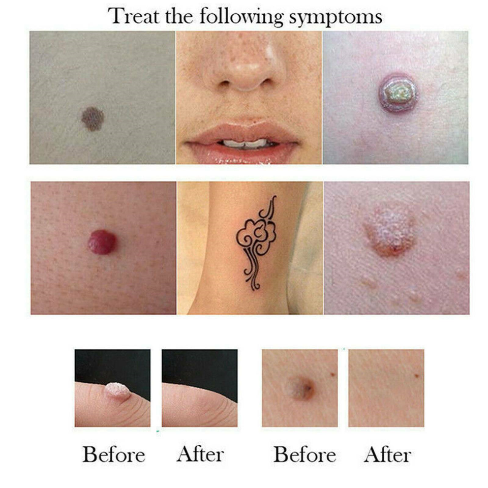 Replace Tips For Beauty Monster Fibroblast Plasma Pen Spot Removal (6PCS=1set ) | eBay