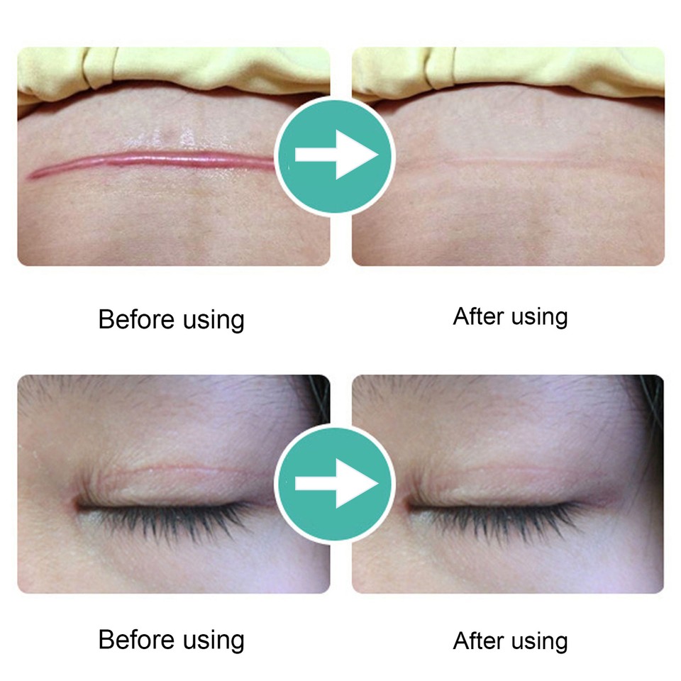 Silicone Scar Removal Sheets Gel Scar Patch C Section Keloid Scar ...