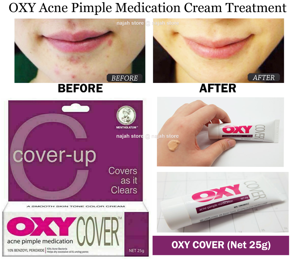 Face Medication Acne Pimple Treatment Cream OXY Kills Bacteria Fast ...