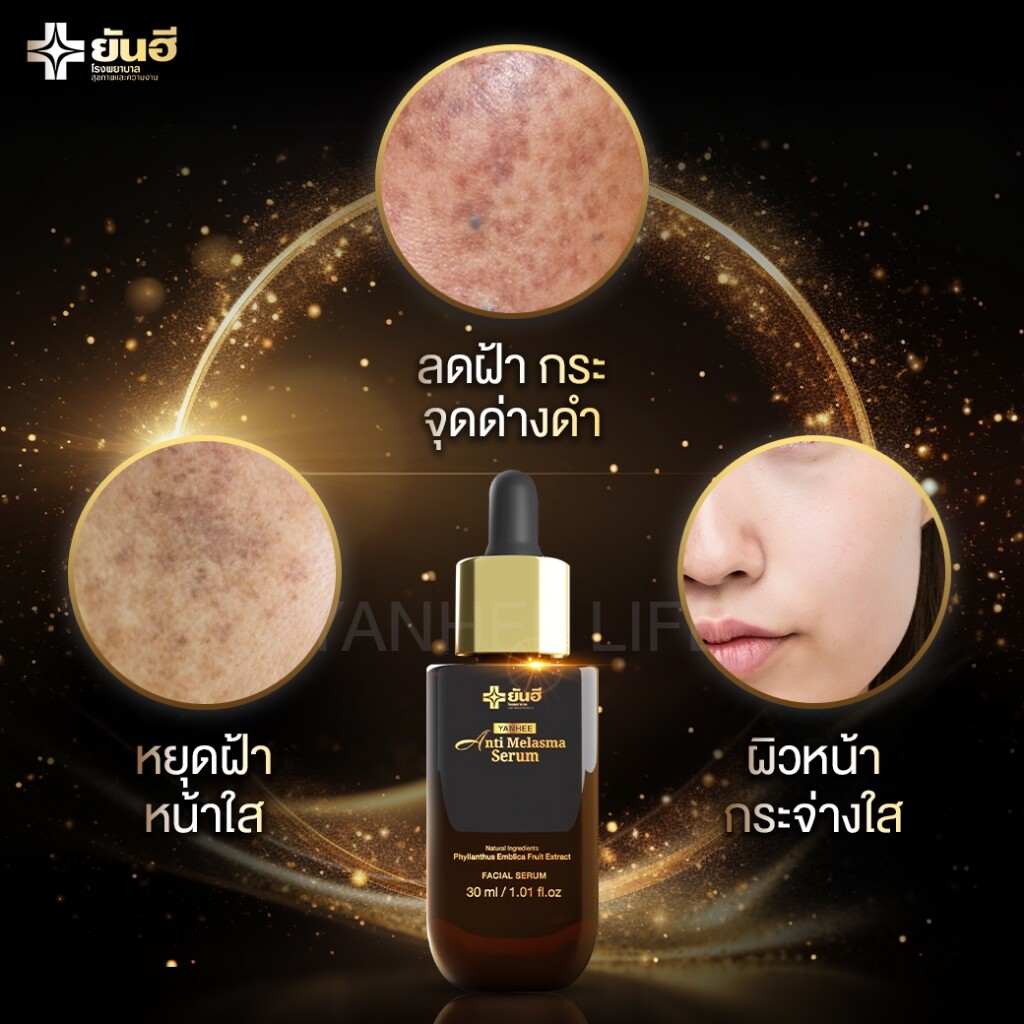 ANTI MELASMA SERUM Reduce Blemishes Freckles Dark Spots Uneven Skin ...
