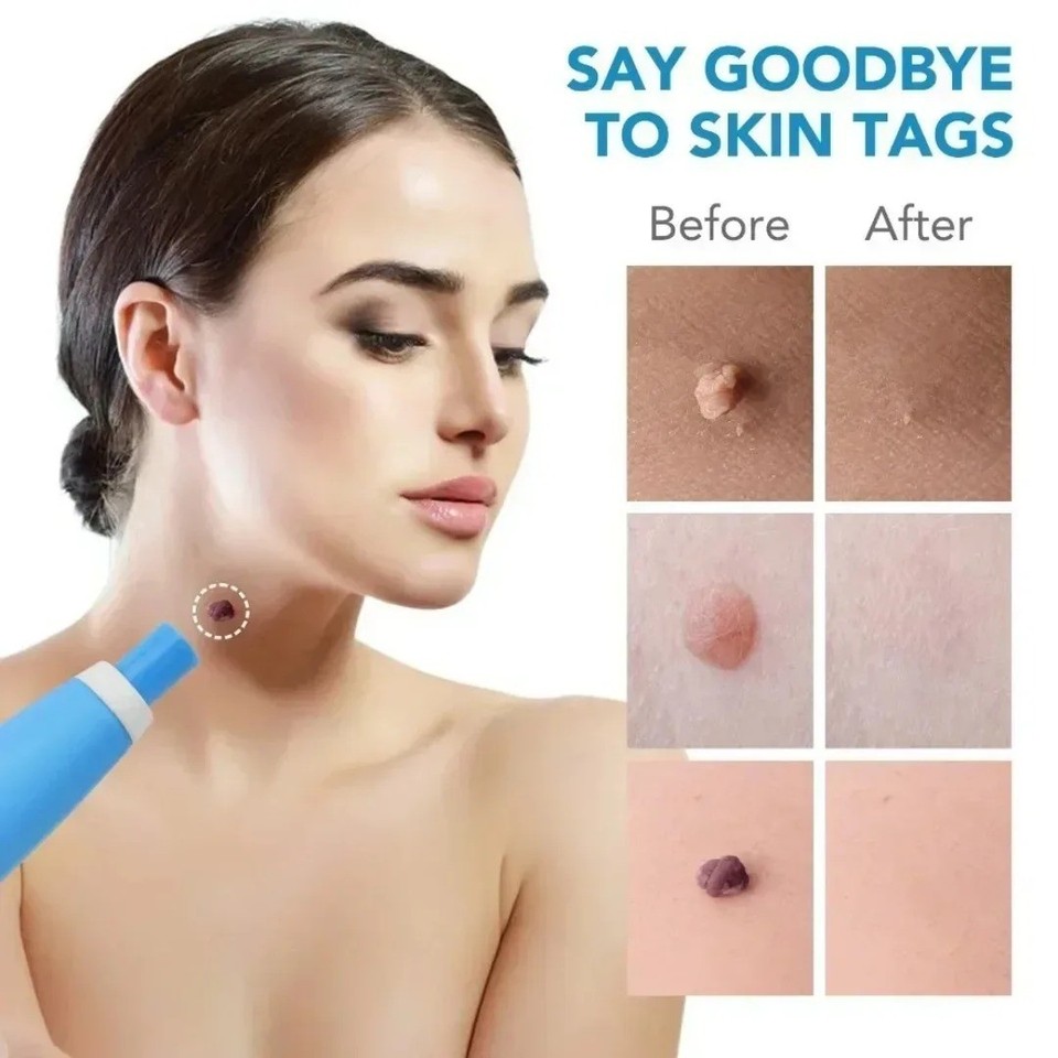 Natural Painless Auto SKIN TAG Removal Kit Skin Tag Micro Bands Remover ...