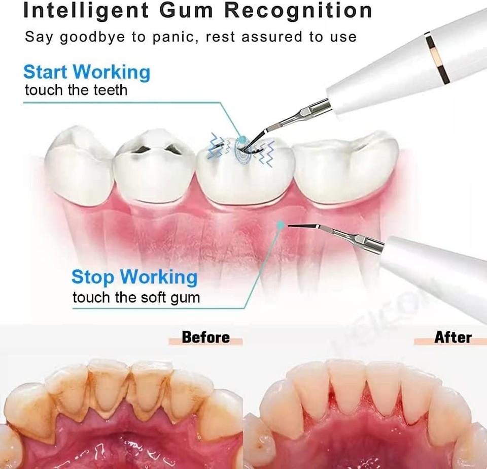 Ultrasonic Tooth Dental Plaque Calculus Stain Remover Teeth Cleaning ...