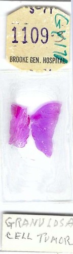 Human Granulosa Cell Tumor Pathology Microscope Slide | eBay