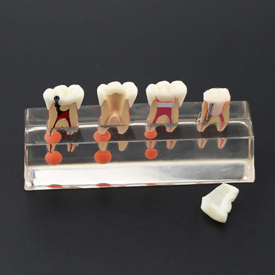 Dental Endodontic Treatment 4 Stage Teeth Study Demo Model Demonstrates ...
