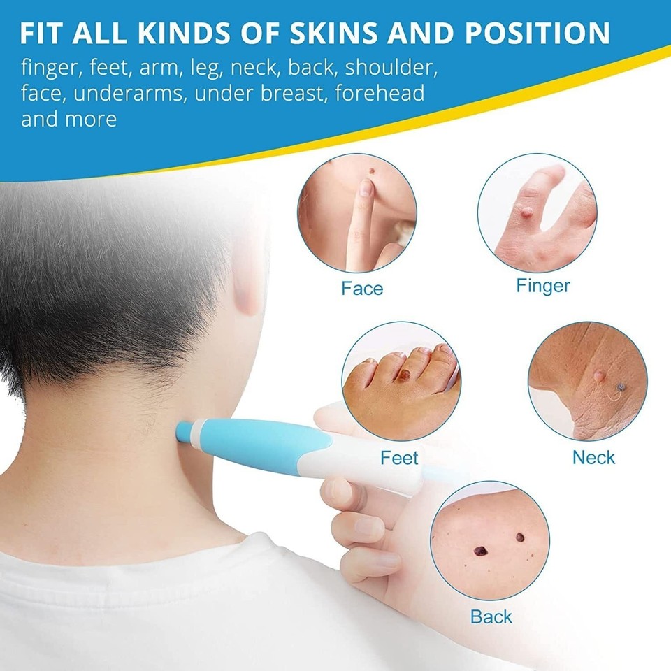 Auto Micro Skin Tag Remover Device Kit Safe Painless Removal 2-8 mm ...