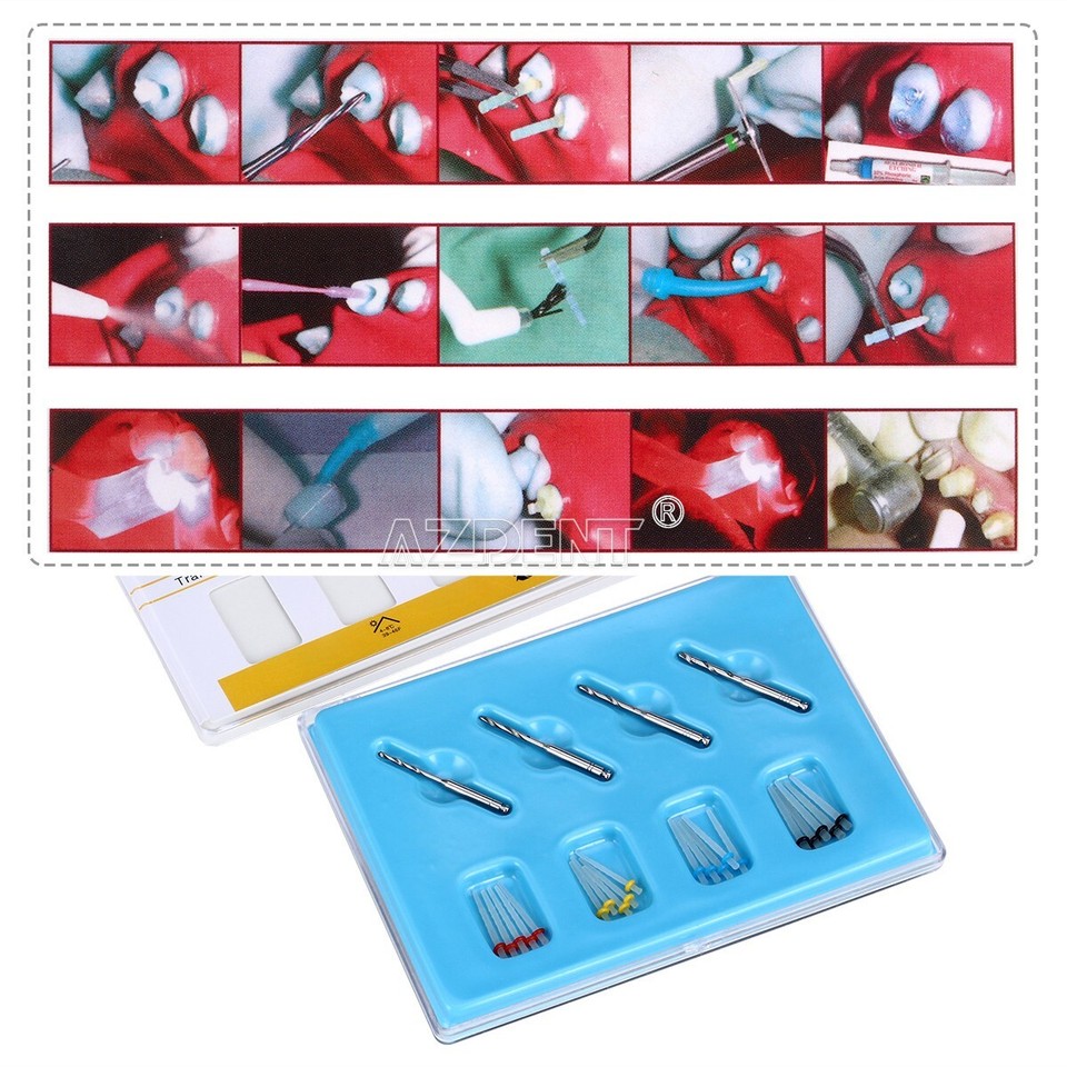 Dental Endodontic Posts Endo Fiber Post Kit 1.2mm 1.4mm 1.6mm 1.8mm +4 ...