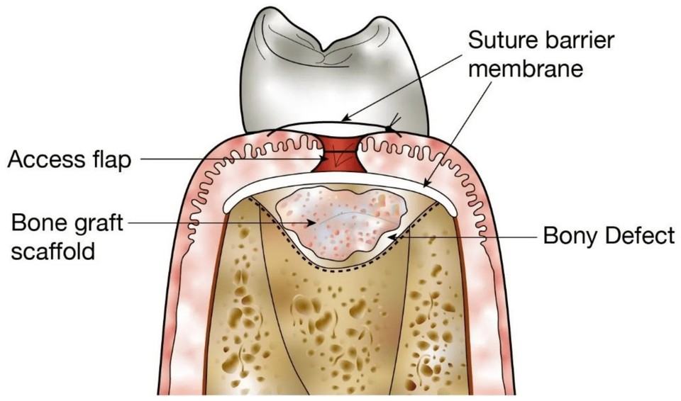 Advanced Biotech Osseograft Bone Matrix (DMBM-XENOGRAFT) for Bone void ...