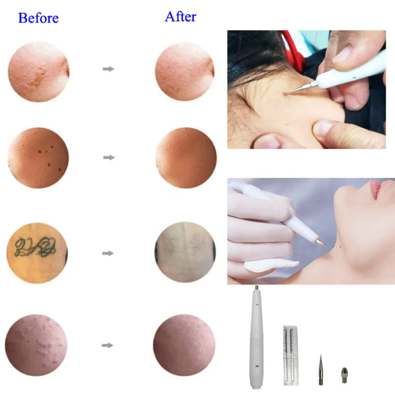 Warts Removal Skin Tag Remover Beauty Instrument Skin Tag Removal ...