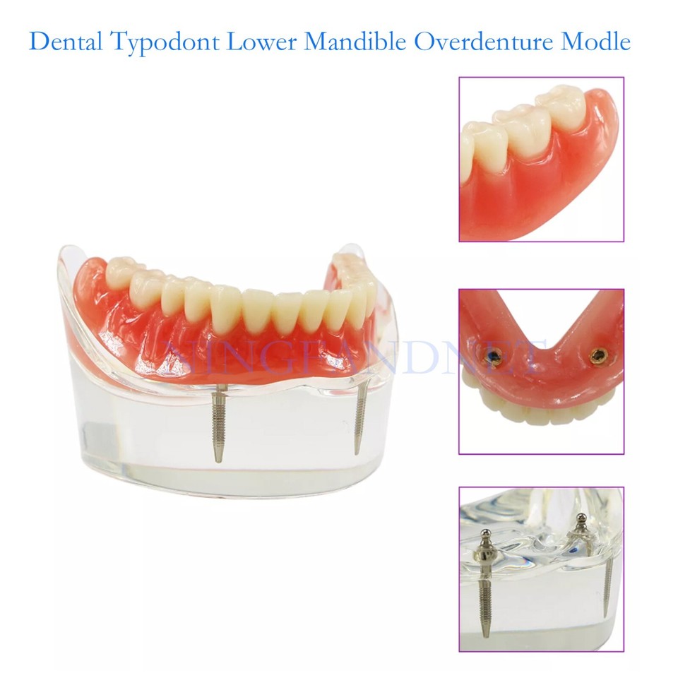 Dental Implant Modle,Lower Upper Jaw,RPD Dentures,Overdenture ...