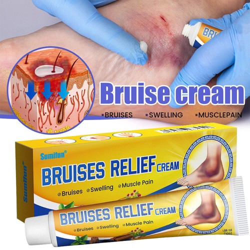 Bruises Relief Cream For Bruises And Swelling Relieves Collision ...