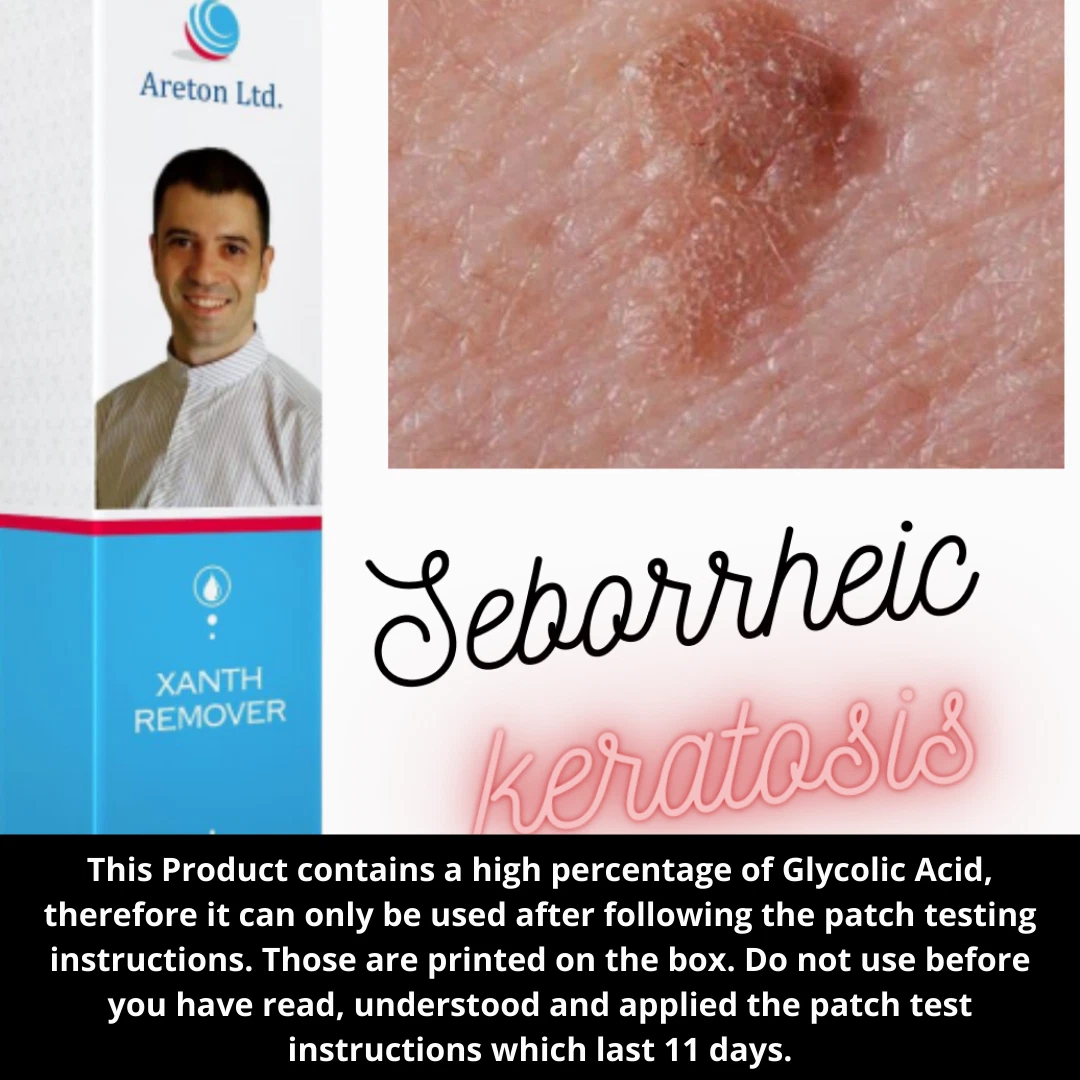 Seborrheic Keratosis Face
