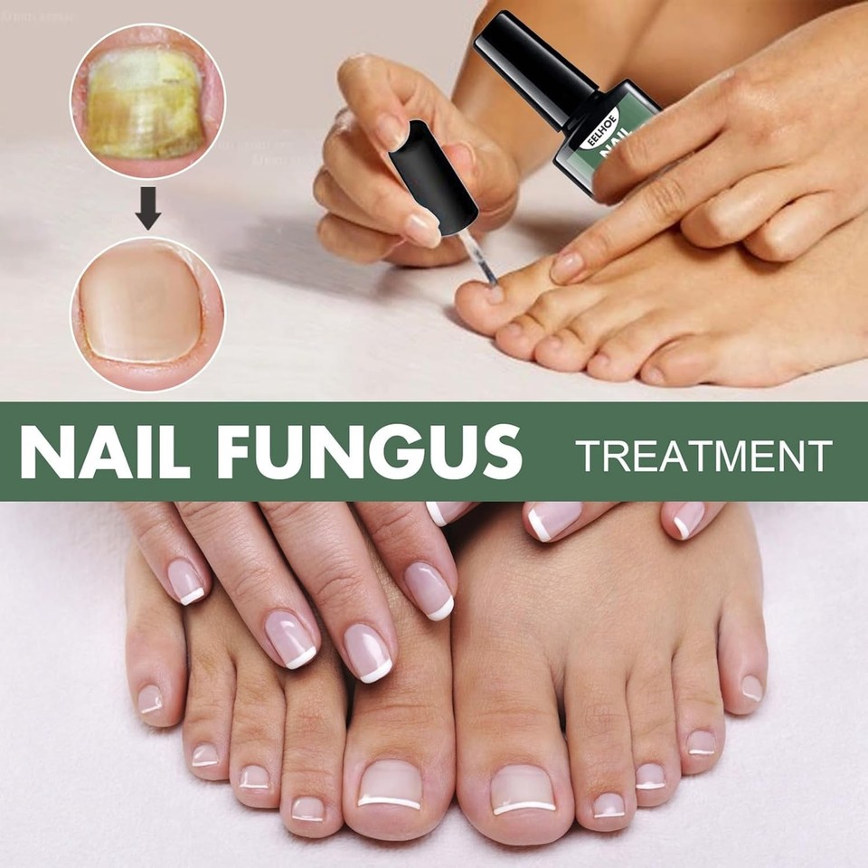 Fungal Nail Treatment - Extra Strong Nail Fungus Treatment for Toenail ...