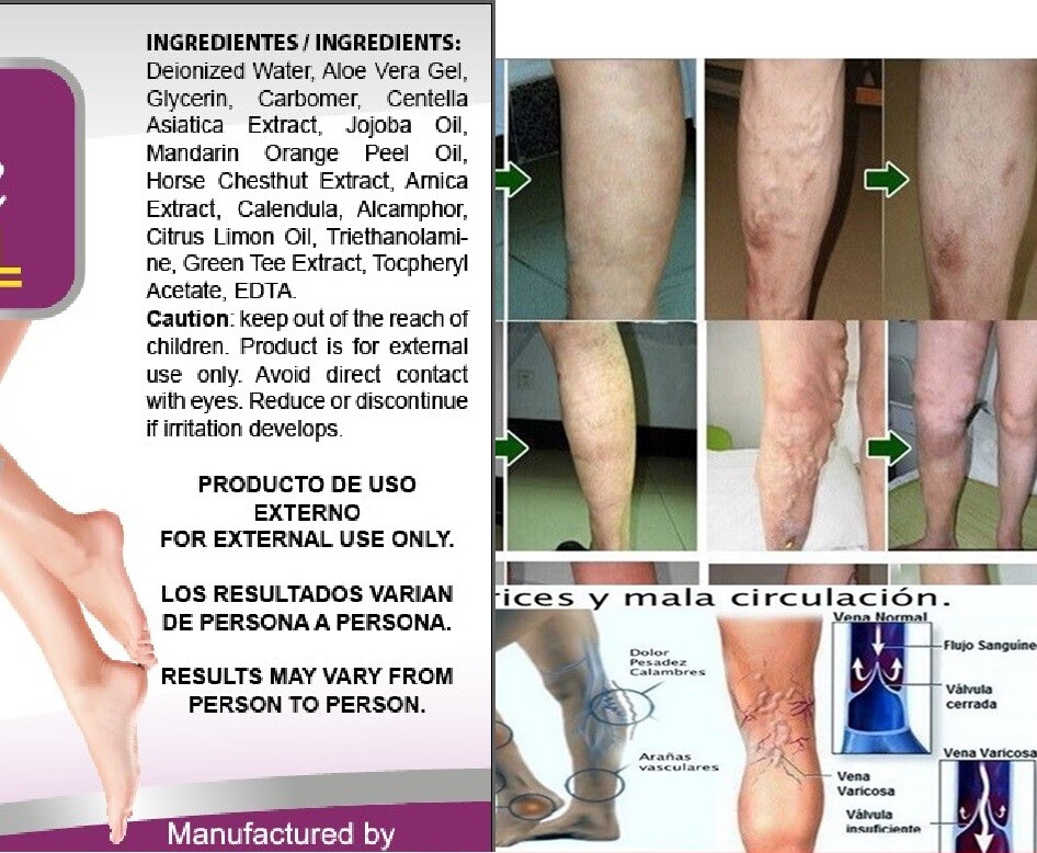 leg Vein Cream Varicose Veins Cream SUPPORT 8 FL OZ blood vein veins ...