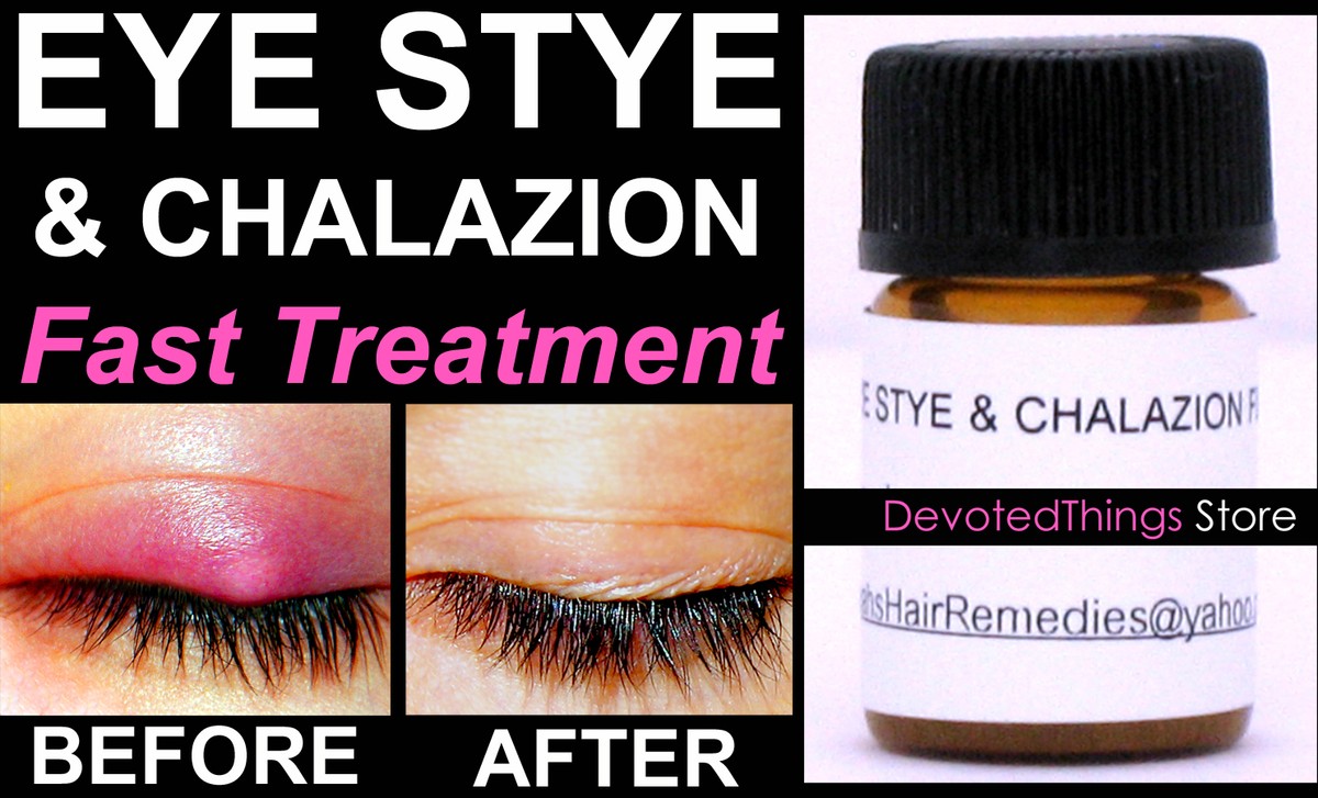 Eye Makeup Remover And Styes - Makeup Vidalondon