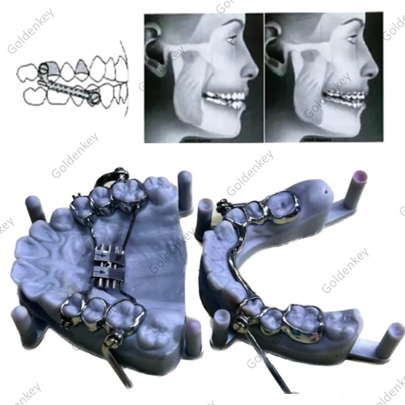 Dental Dentaurum Herbst Socket Screw Appliance Telescopic Orthodontic ...