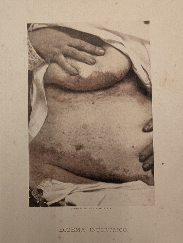 Antique Artotype Photo Print Skin Condition 1886 E.B Treat Exzema ...