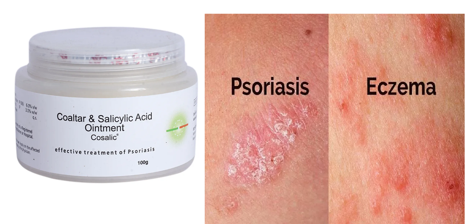 Coal tar & Salicylic Acid Topical Ointment 50g- Hair & Scalp Psoriasis ...