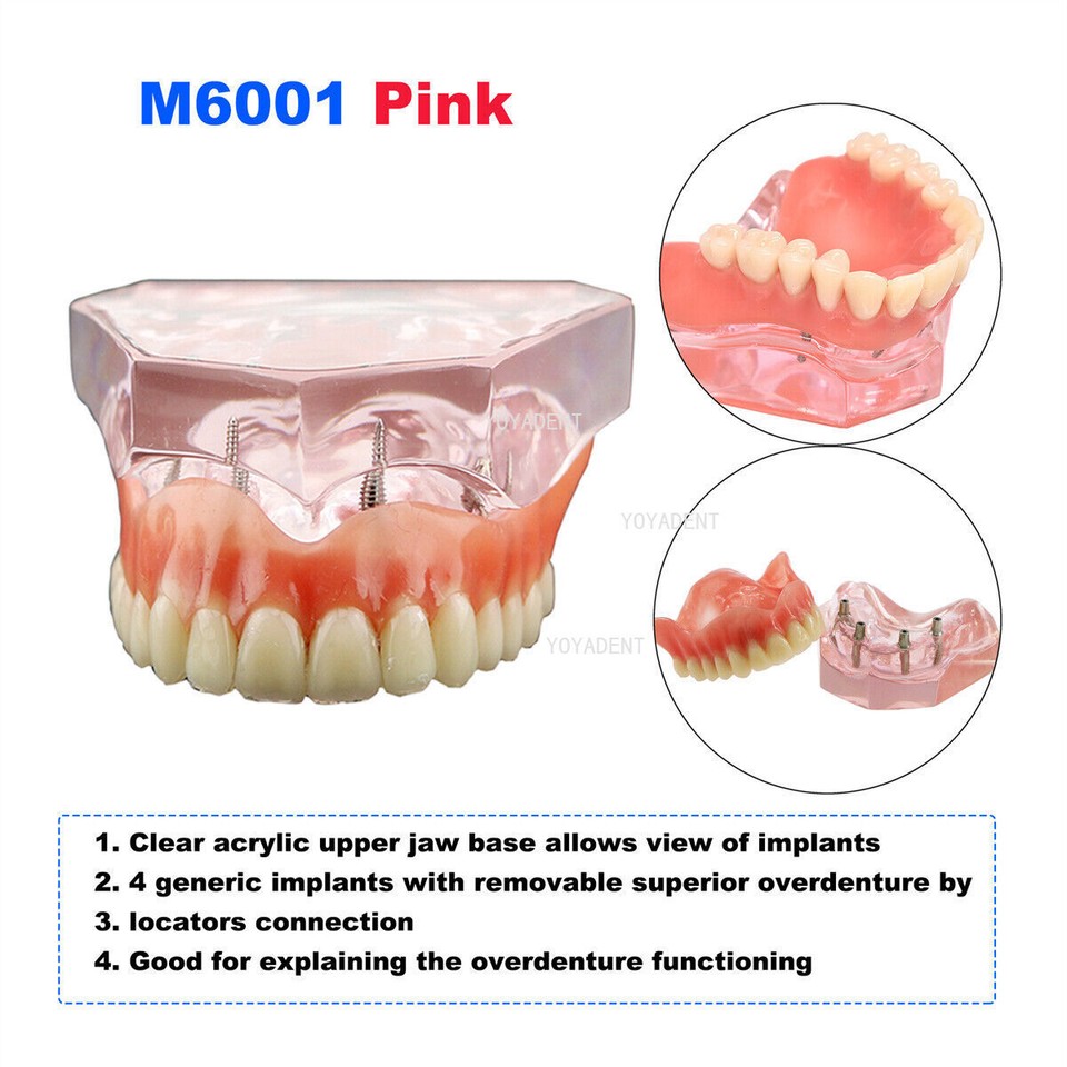 Dental Model 4 Implants superior/Mandibular Removable Overdenture Teeth ...