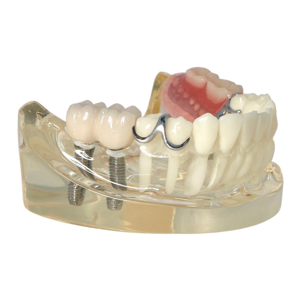 Dental Crown Restoration Model Demonstration With Partial Denture Tooth ...