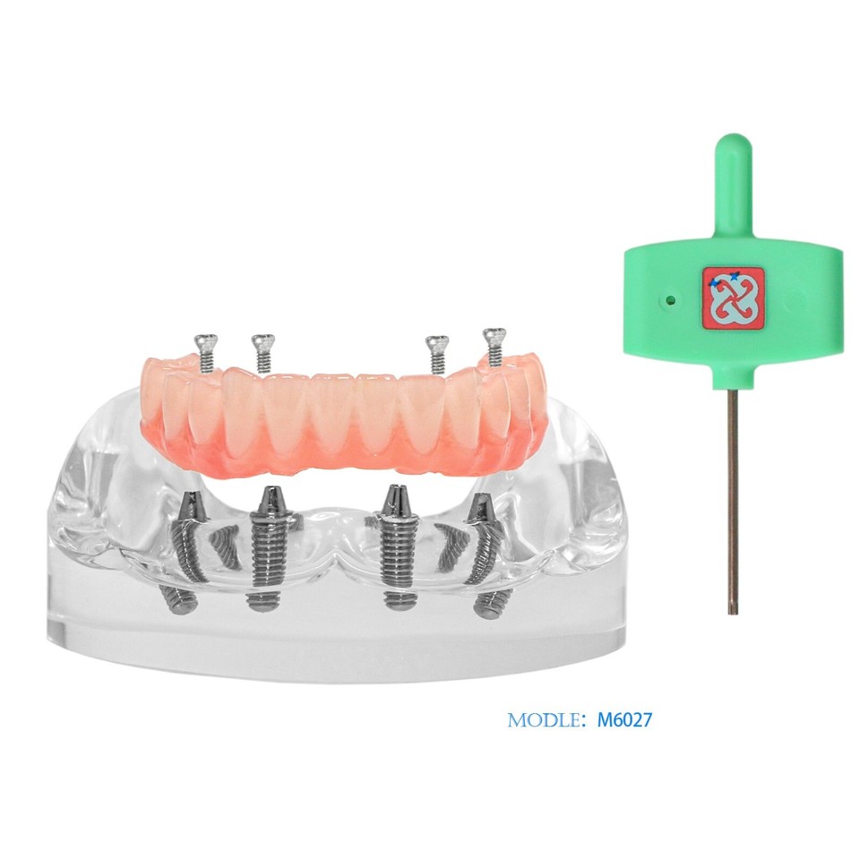 Dental Implant Modle,Lower Upper Jaw,RPD Dentures,Overdenture ...