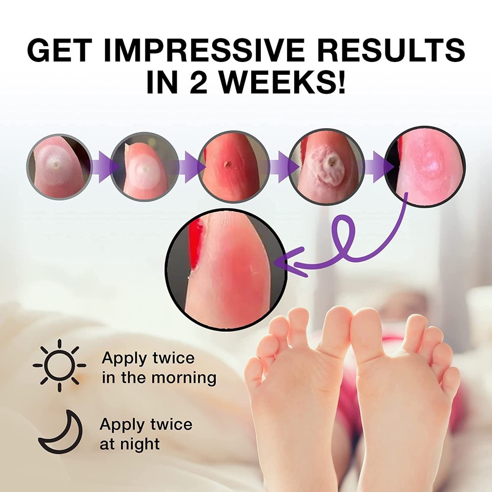 Foot Corn Remover: Liquid for Toes and Feet; Effective Corn and Callus ...