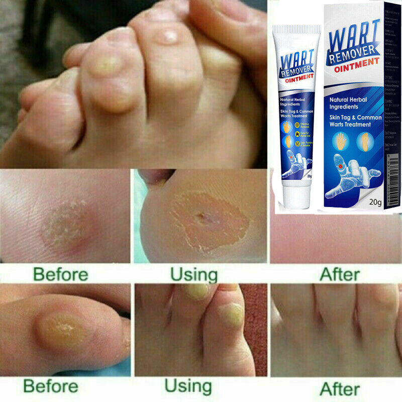 Filiform Wart Removal