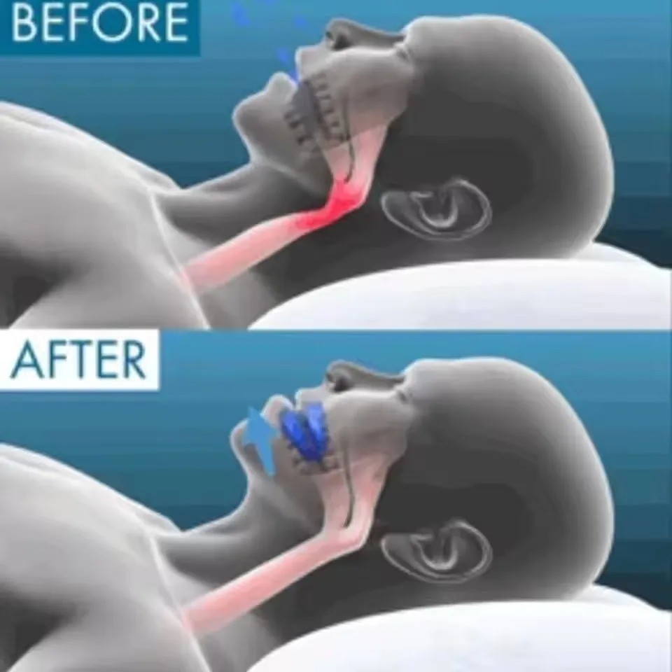 Honex Anti Snoring Mouthpiece Reduce Snoring Aid, Snore Solution For ...