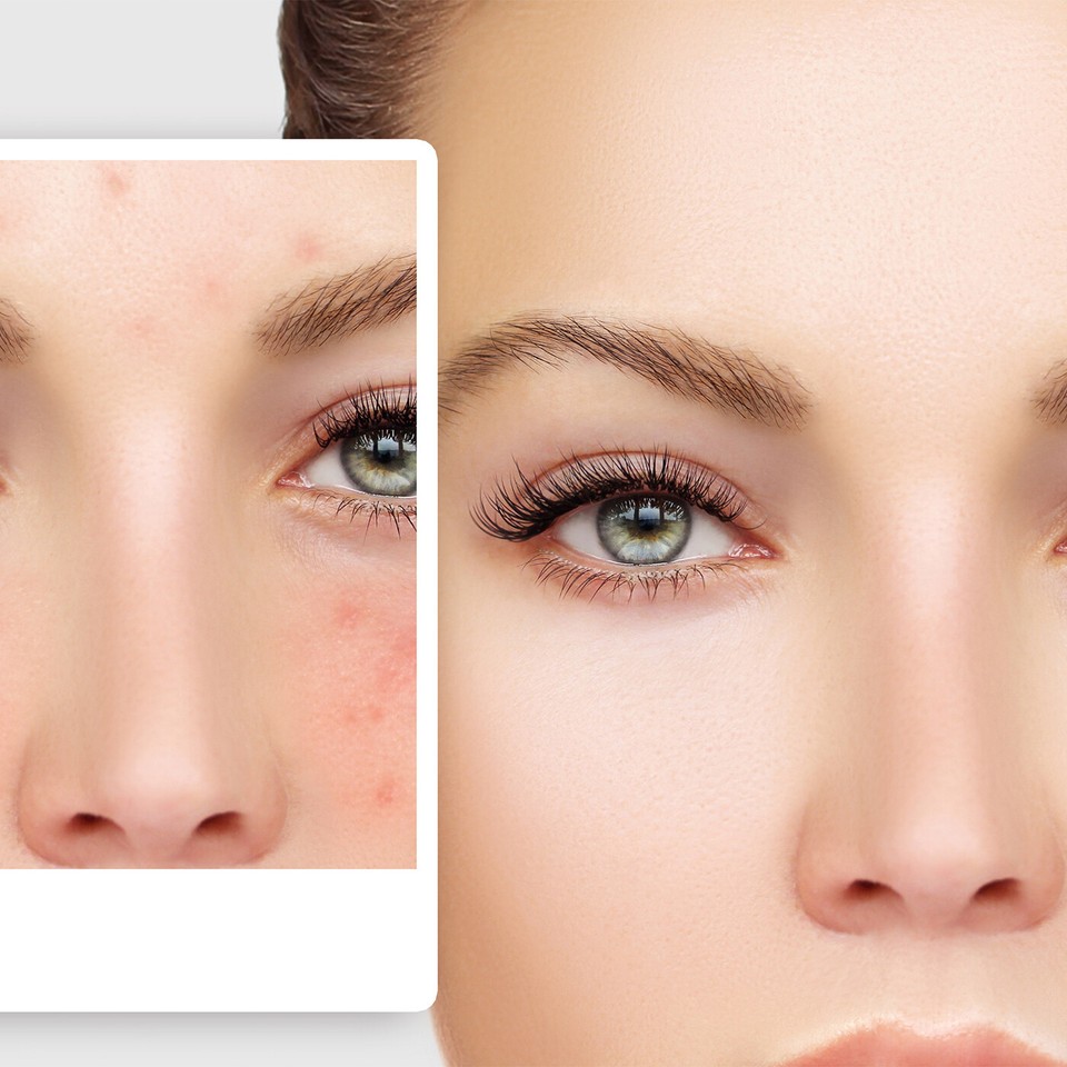Salicylic Acid 15% Skin Peel -exfoliate & smooth, blackheads/scars FREE ...