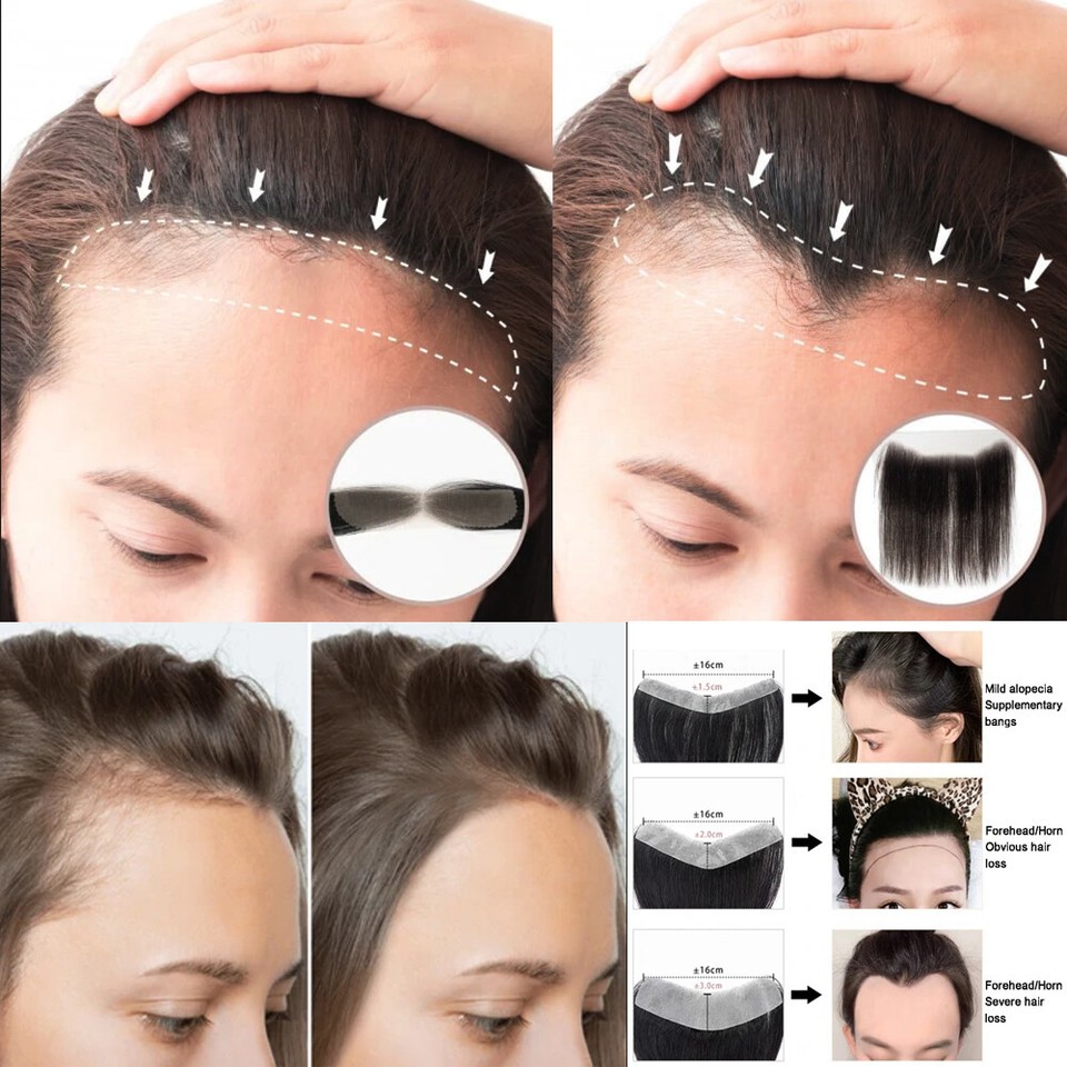 Frontal Full Lace Receding Hairline Cover-up Human Hair Patch Piece For ...