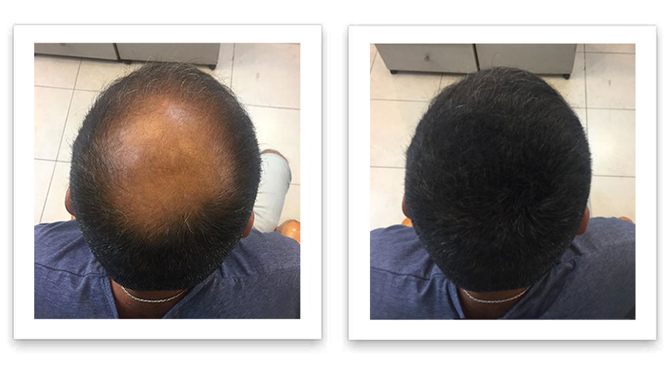 FEBRON Hair Building Fibers 30gm - For Thinning Hair Cover Bald spots ...