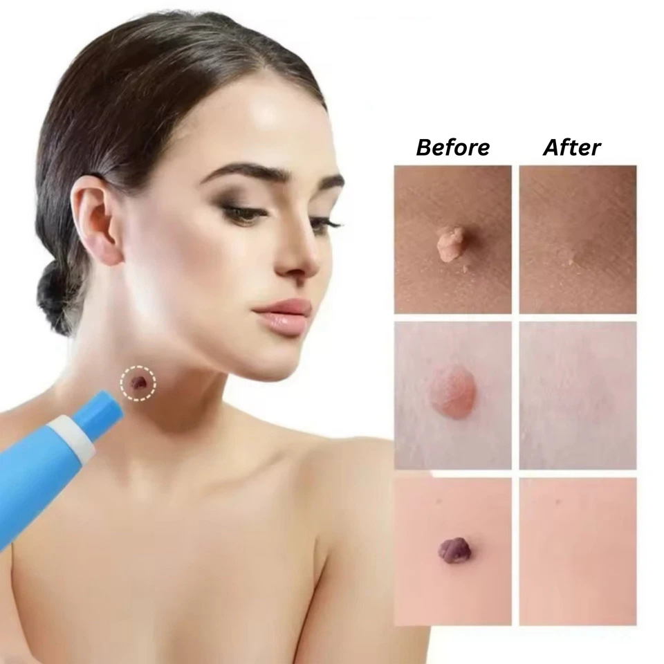 2-IN-1 Auto Skin Tag Removal Tool Kit Painless Skin Label Mole Acne ...