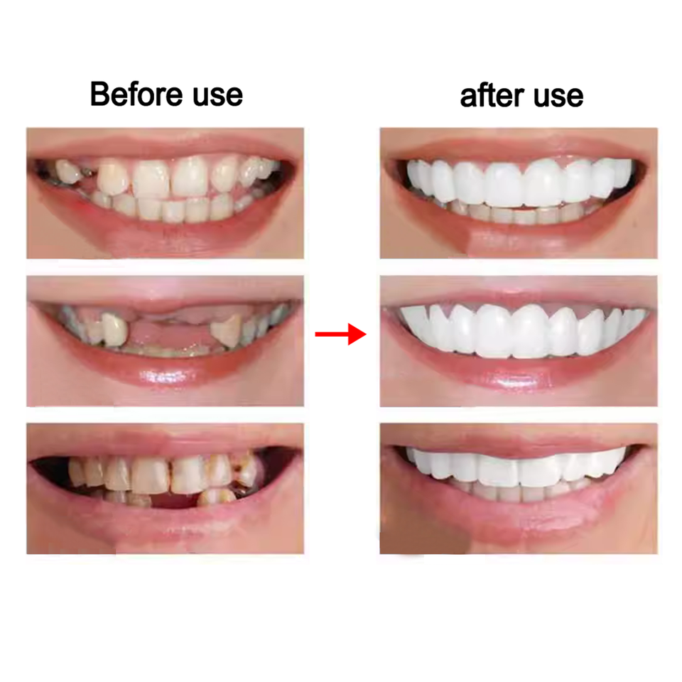 Smile Snap On Upper + Lower False Teeth Dental Veneers Denture Tooth ...