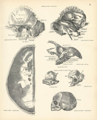 Anatomy. Temporal Bone Adult & New-Born. Foetus Skull. Fornix Cranii ...