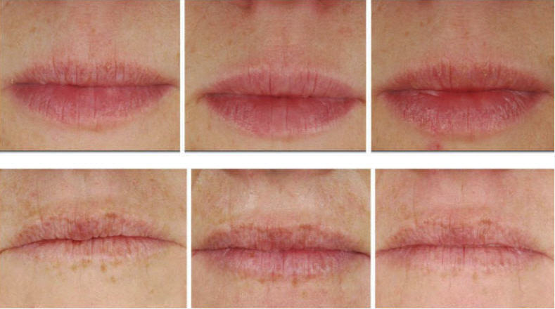 TRIPLE SMOOTH UPPER LIP WRINKLE CREAM REMOVE WRINKLES ON THE LIPS | eBay